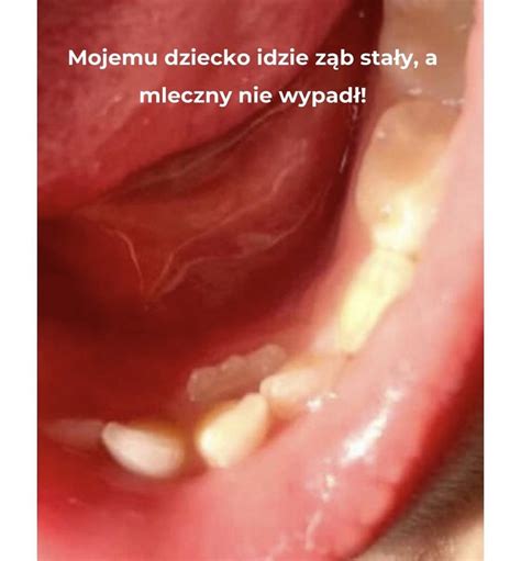 Mojemu dziecku idzie ząb stały a mleczny jeszcze nie wypadł Tata