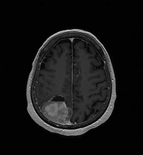 Can Gene Expression Predict If A Brain Tumor Is Likely To Grow Back