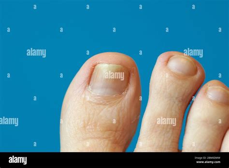 Ingrown Toenail High Resolution Stock Photography And Images Alamy