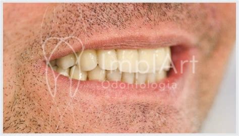 Protese Metaloceramica 48kb ImplArt