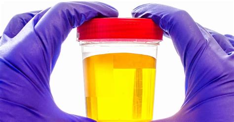 What Is The Meaning Of Dark Yellow Urine Universum Medical