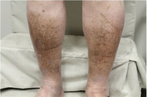 Stasis Dermatitis An Overview Of Its Clinical 51 Off