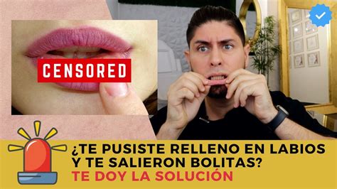 Bolitas en los labios por RELLENO con ÁCIDO HIALURÓNICO DOCTOR LEMUS