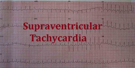 Supraventricular Tachycardia Types Causes Symptoms And Treatment