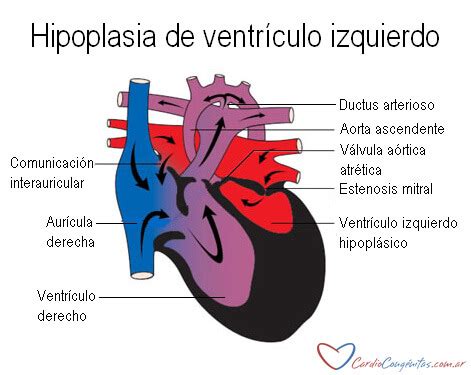 Síndrome de corazón izquierdo hipoplásico