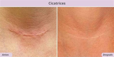 Clínica Láser de Piel Cicatrices de Acne queloides e hipertróficas