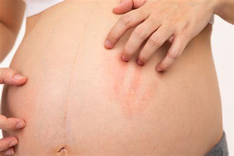 Pruritic Urticarial Papules And Plaques Of Pregnancy First Trimester