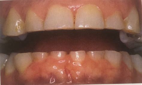 Dental Charting Flashcards Quizlet