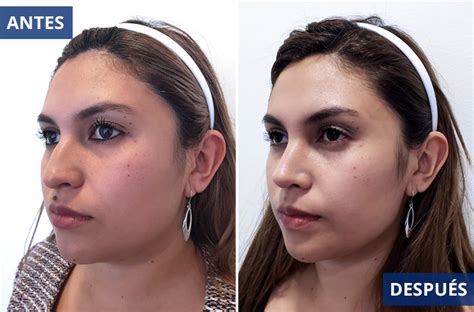 Rinoplastia Antes Y Despu S Dr Nelson Chaves