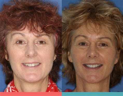 Orthodontics Australia Braces And Changes In Facial Shape And
