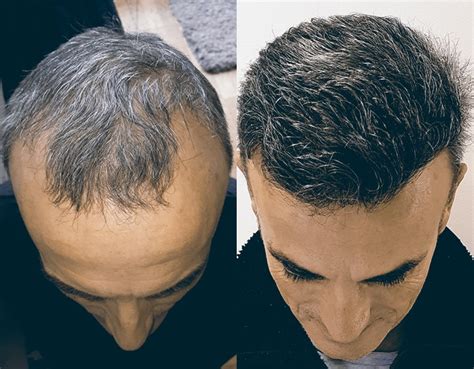 Injerto Capilar Antes Y Despu S Resultados Capilclinic Colombia