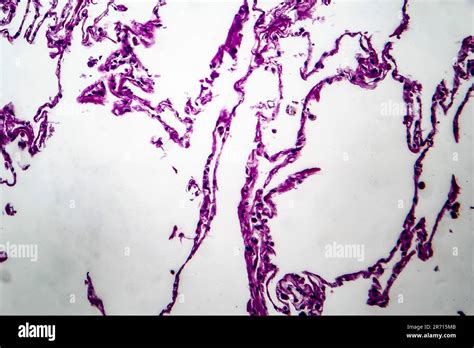 Histopathologie De L Emphys Me Pulmonaire Micrographe L Ger Photo