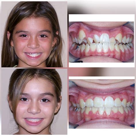 List Pictures Pictures Of Braces On Teeth Before And After Sharp