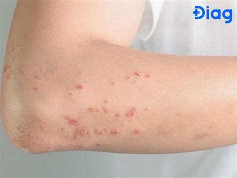 Dấu Hiệu HIV Ở Nam Sớm Nhất Cách Nhận Biết và Biện Pháp Phòng Ngừa