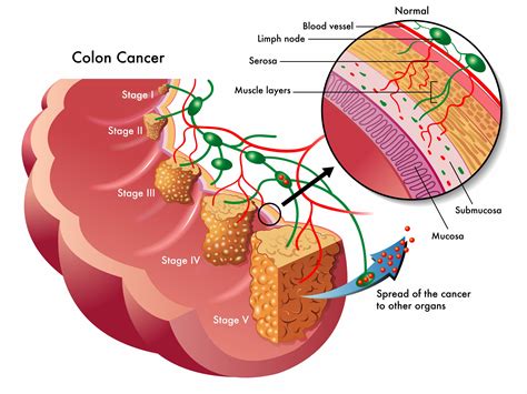 Colorectal Cancer Treatment In Dubai Dubai Gastroenterology Clinic