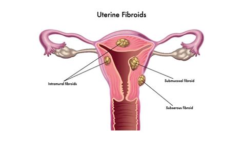 Dr Syal Uterine Fibroid Treatments Woodlands OBGYN Associates