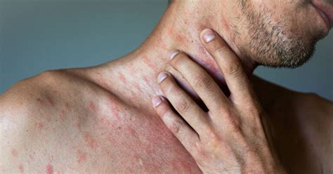 Causas sintomas e tratamentos da Dermatite Atópica