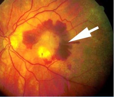 Cosa La Maculopatia Senile Sintomi Diagnosi E Cure Arcibook