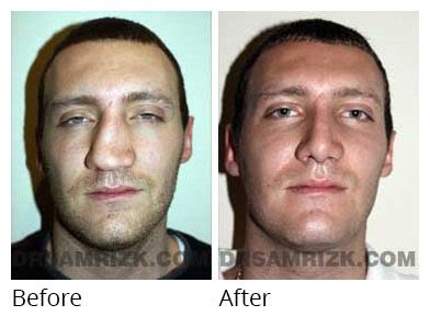 Rhinoplasty Before And After Nose Job Gallery
