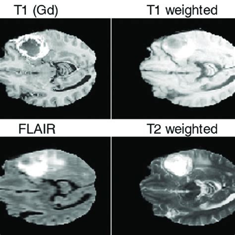 Multiparametric Magnetic Resonance Imaging Of Brats Native T And