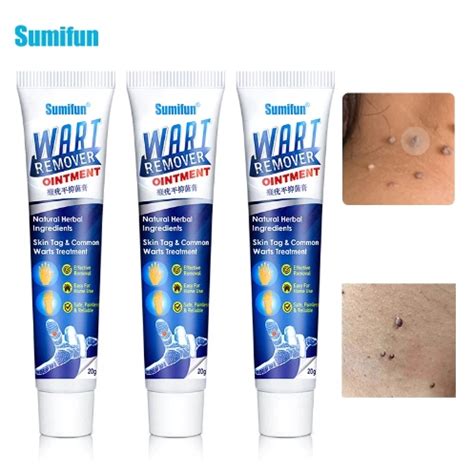 Sumifun Wart Creme Pomada Removedor De Verrugas Manchas Escuras Na Pele