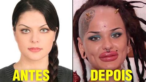 9 Plásticas que Deram MUITO errado Antes e Depois chocante NET Educação