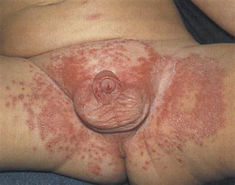 PED Skin Lesion Description Flashcards Quizlet