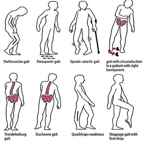 Types Of Gait Physical Therapy Student Physical Therapy Assistant