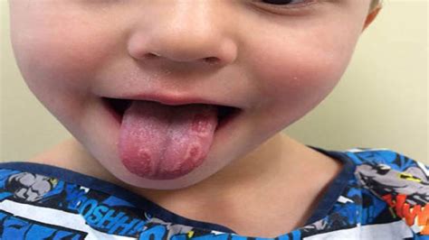Nấm Lưỡi Bản Đồ Ở Trẻ Em Nguyên Nhân Triệu Chứng Và Cách Điều Trị