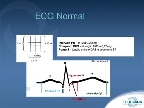 Como Interpretar O ECG Aprenda A Ler O Eletrocardiograma 43 OFF