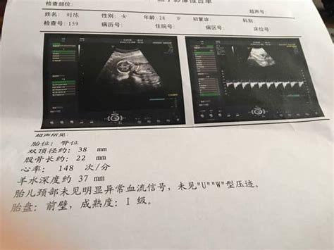 怀孕四个月b超看男女准吗 怀孕七个月b超看性别准吗 随意云