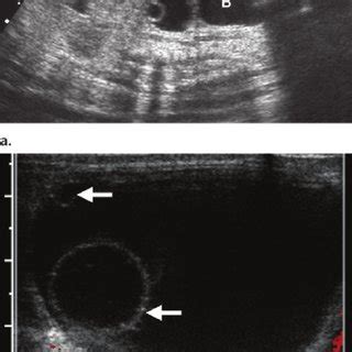Enteric Duplication Cyst A Axial Fetal Us Image Shows An Enteric