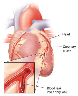 Spontaneous Coronary Artery Dissection SCAD Saint Luke S Health System