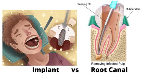 Dental Root Canal Vs Implant Dental Care Tips