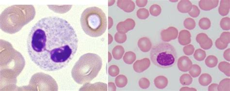 Wbc Disorders Hematology Exam Flashcards Quizlet