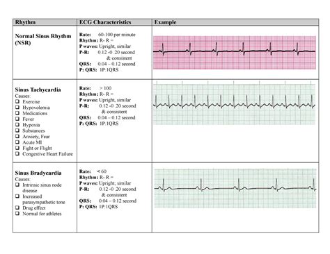 EKG Cheat Sheet EKG Normal Sinus Rhythm NSR Rate 60 100 Per