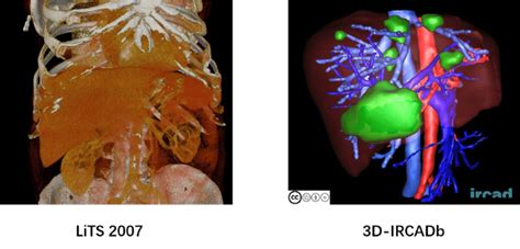 the scans in liver tumor segmentation challenge lits 2017 dataset and download scientific