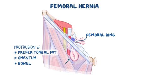 Video Femoral Hernias Clinical Sciences