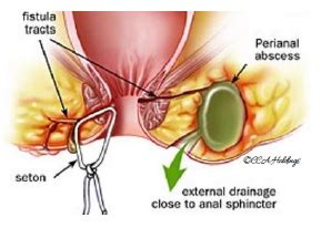 Anal Abscess Drainage Hot Naked Pics Comments