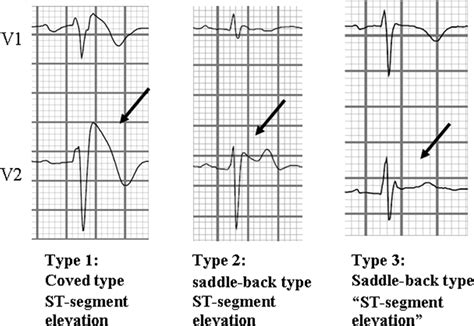 Brugada Syndrome Circulation Arrhythmia And Electrophysiology