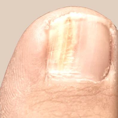 Diagnose Von Nagelerkrankungen Mit Fotos