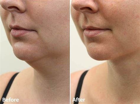 Dr Darm LipoLift Neck Before And Afters JA 2