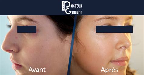 Rhinoplastie à Lyon chirurgie esthétique du nez Dr Gounot