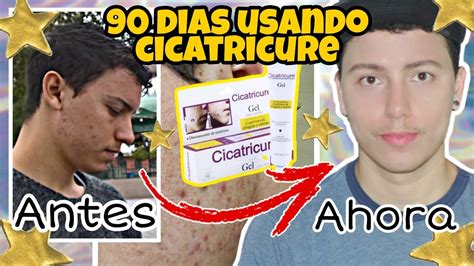 El mejor tratamiento para eliminar CICATRICES de ACNÉ Use CICATRICURE