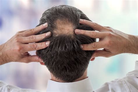 Alopecia Tipologie Sintomi E Cure Inran