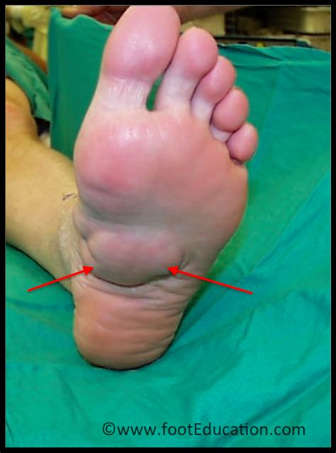 Plantar Fibroma FootEducation