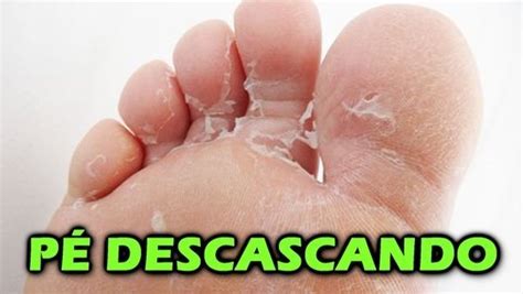 Pés descascando 5 principais motivos Buscar Saúde