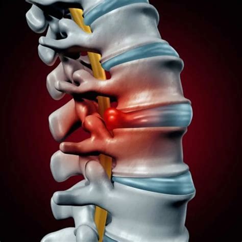 Tratamiento Fisioterap Utico Para Hernia Discal Efisio Fisioterapia
