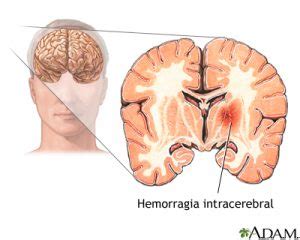Hemorragia Intracerebral Conoce sus Causas y Síntomas AngioTeam