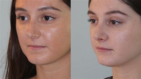 Deviated Septum Surgery Before And After
